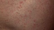 Light Red Spots On Skin Infoupdate
