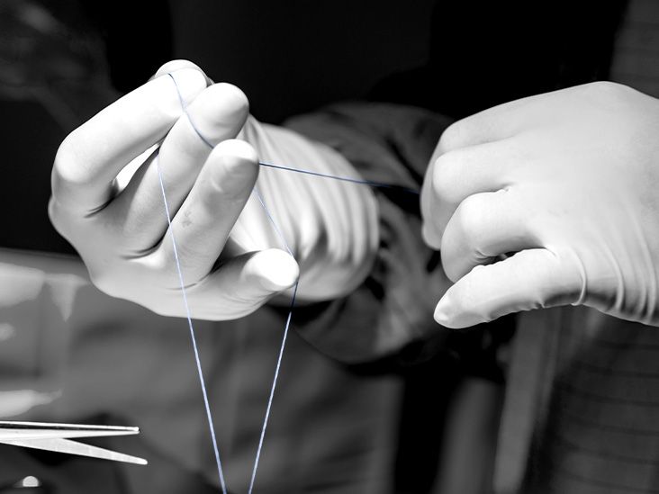 Surgical sutures: Types, techniques, and how to take care of them