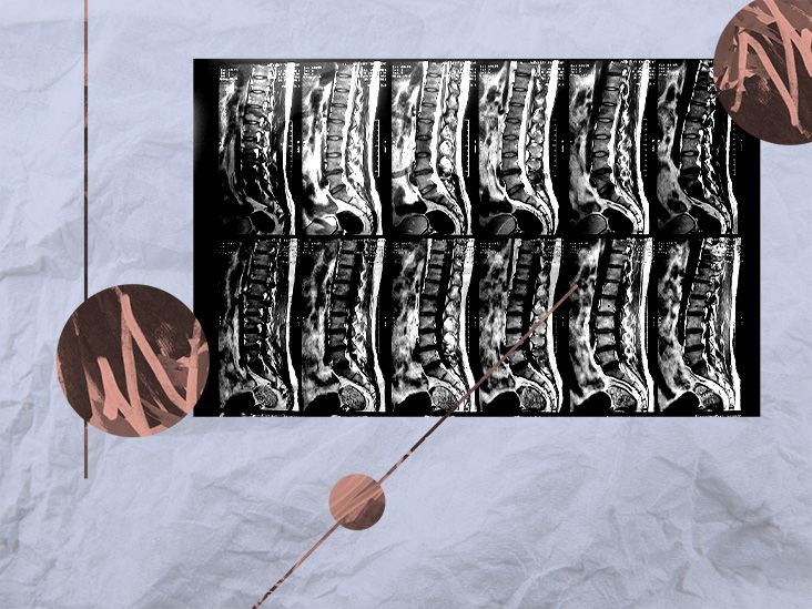 Spondylosis: Causes, risk factors, and symptoms