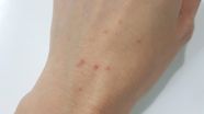 Sea Lice