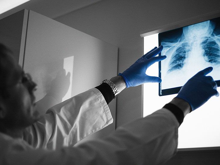 Thyroid cancer metastasis: Definition, signs, and more