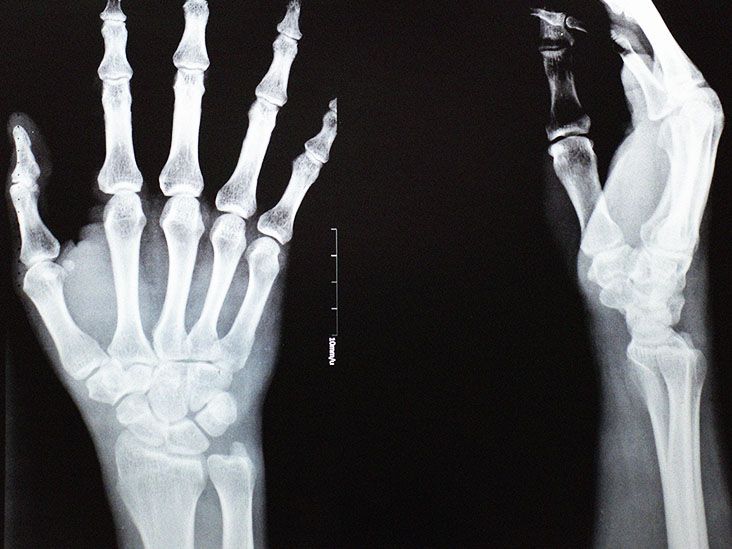 Chondromas: Symptoms, treatment, and more