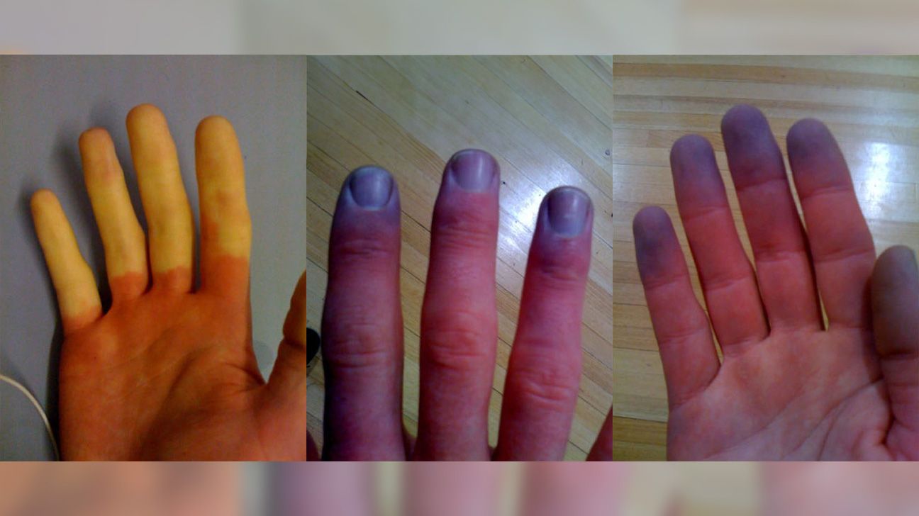 Why My Finger Joints Hurt