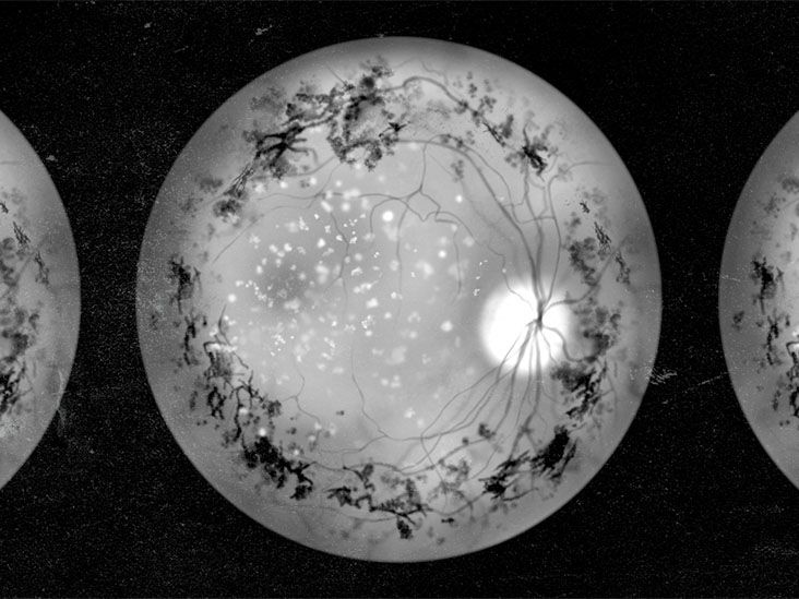 History Of Retinitis Pigmentosa at Kathleen Northcutt blog