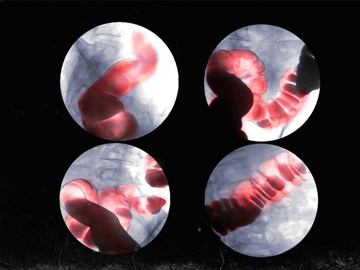 Post-esophagoscopy: Complications and when to contact a doctor