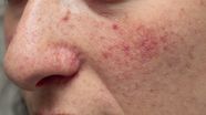 Small Red Spots On Face Pregnancy Infoupdate