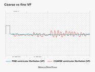 Coarse Ventricular Fibrillation