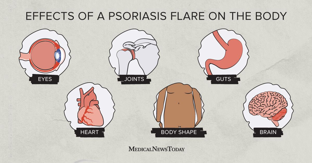 A visual guide to psoriasis flares inside the body