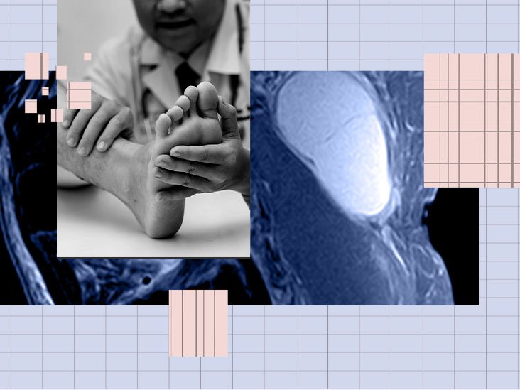 Cysts: Types and causes