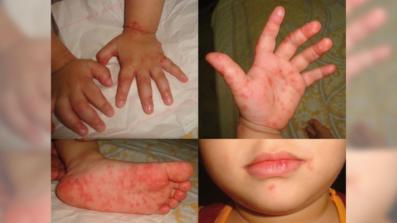 Swollen Joints Rash Fever Child - Infoupdate.org