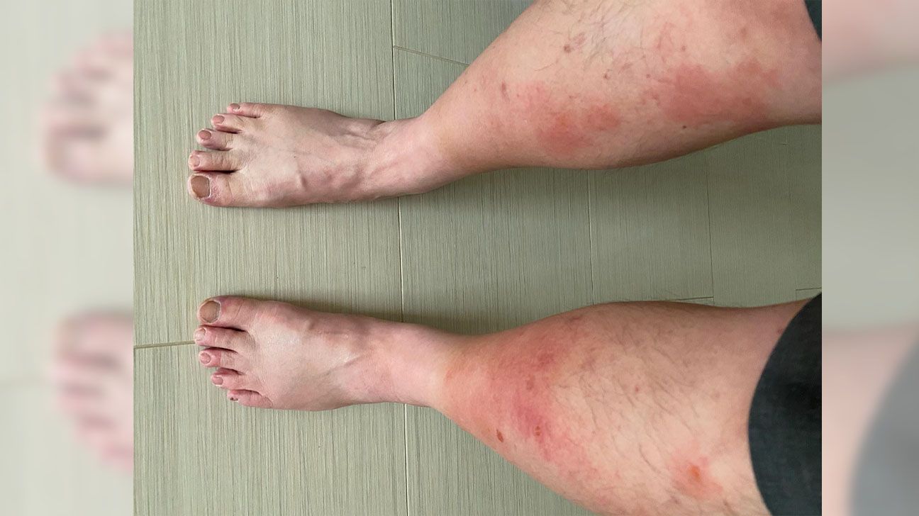 Cellulitis From Bug Bites Signs Symptoms And Treatment