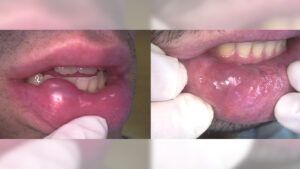 Are Bumps On Your Lips Contagious - Infoupdate.org