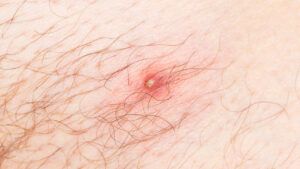 Ingrown Hair Cyst Groin