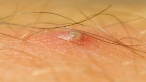 Ingrown Hair Groin Lump Razor Bumps: How To Treat And Prevent Them