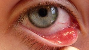 Giant Abscess On Eyelid