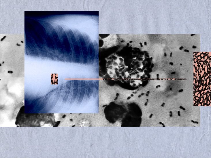 Pneumonic plague: Symptoms, causes, treatment, and more