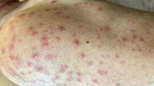 Syphilis Face Rash Rash Caused By Syphilis, Vintage #1 Face Mask By