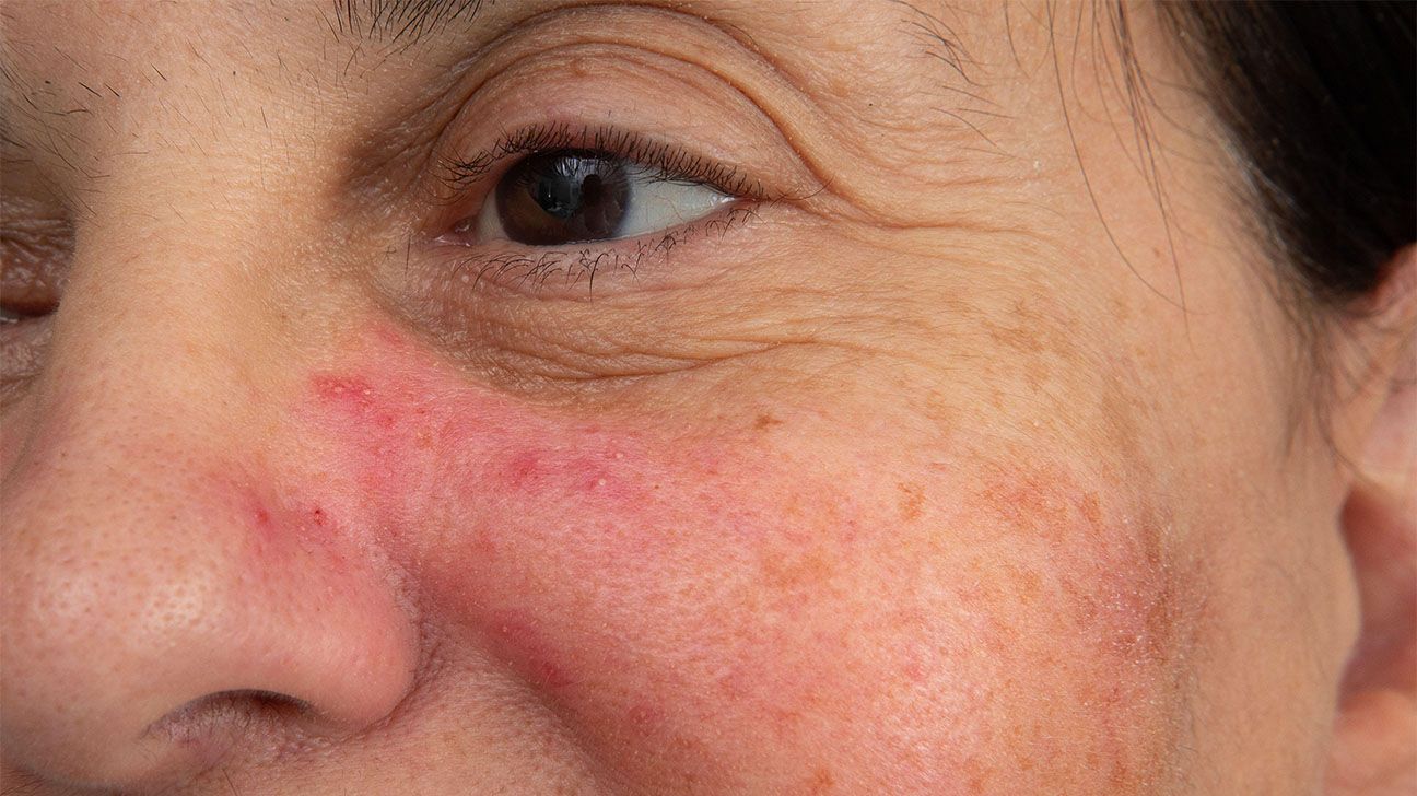 Mild Seborrheic Dermatitis Face
