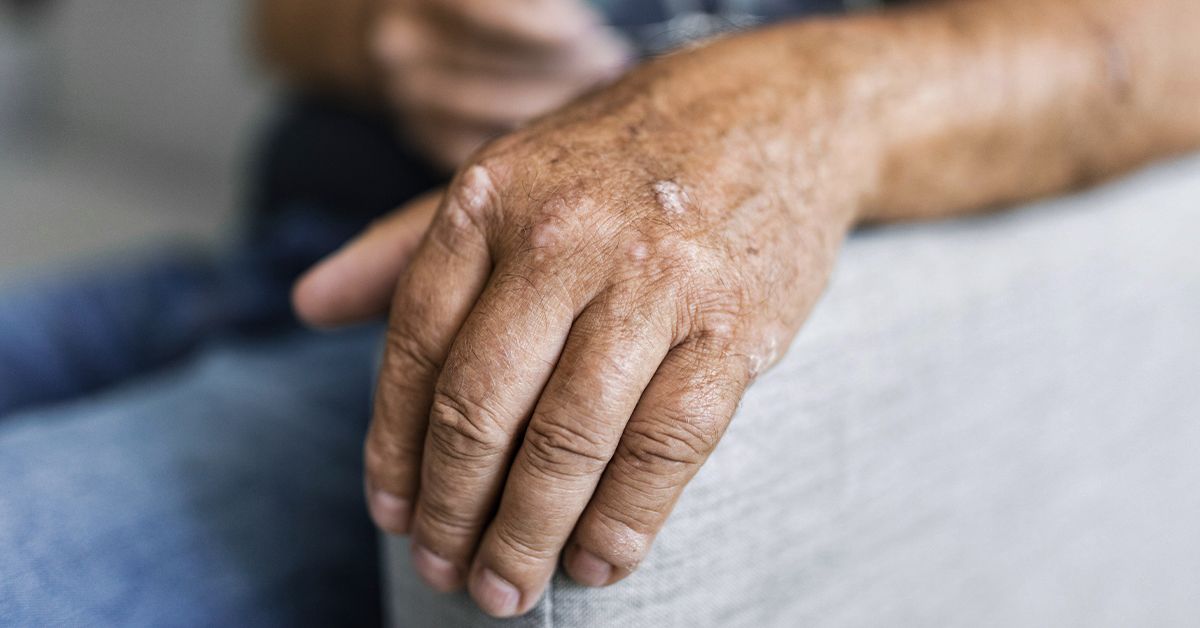 All about psoriatic arthritis: 14 quick facts