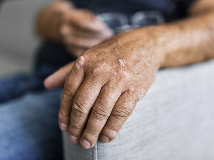 All about psoriatic arthritis: 14 quick facts