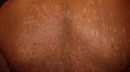 Why Do I Have White Spots On My Body That Won T Tangle Infoupdate