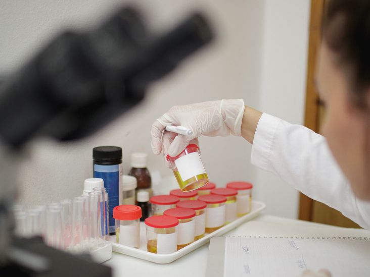 Epithelial cells in urine: Test results, types, and causes