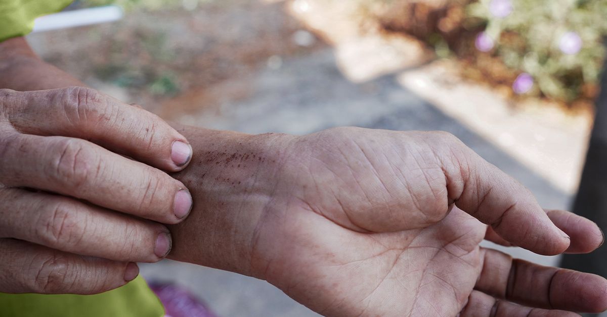 Dermatitis neglecta: Causes, pictures, and treatment