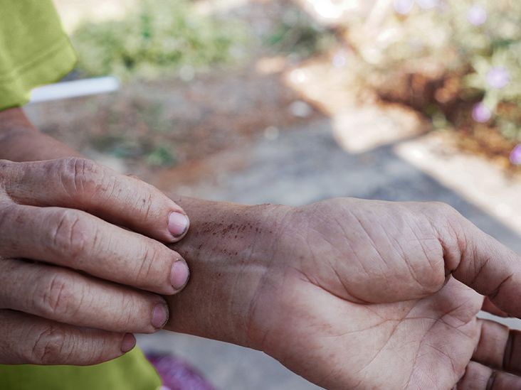 Dermatitis neglecta: Causes, pictures, and treatment