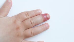 Cellulitis Finger