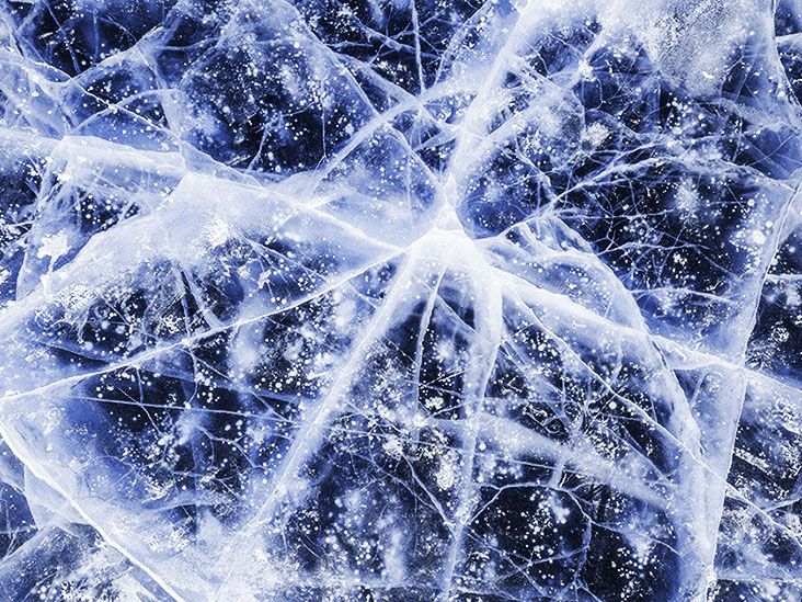 Breast cancer: Cryoablation ‘ice treatment’ works against large tumors