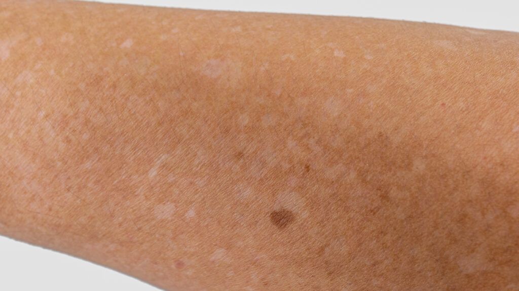 White Bumps On Skin Hives NHS