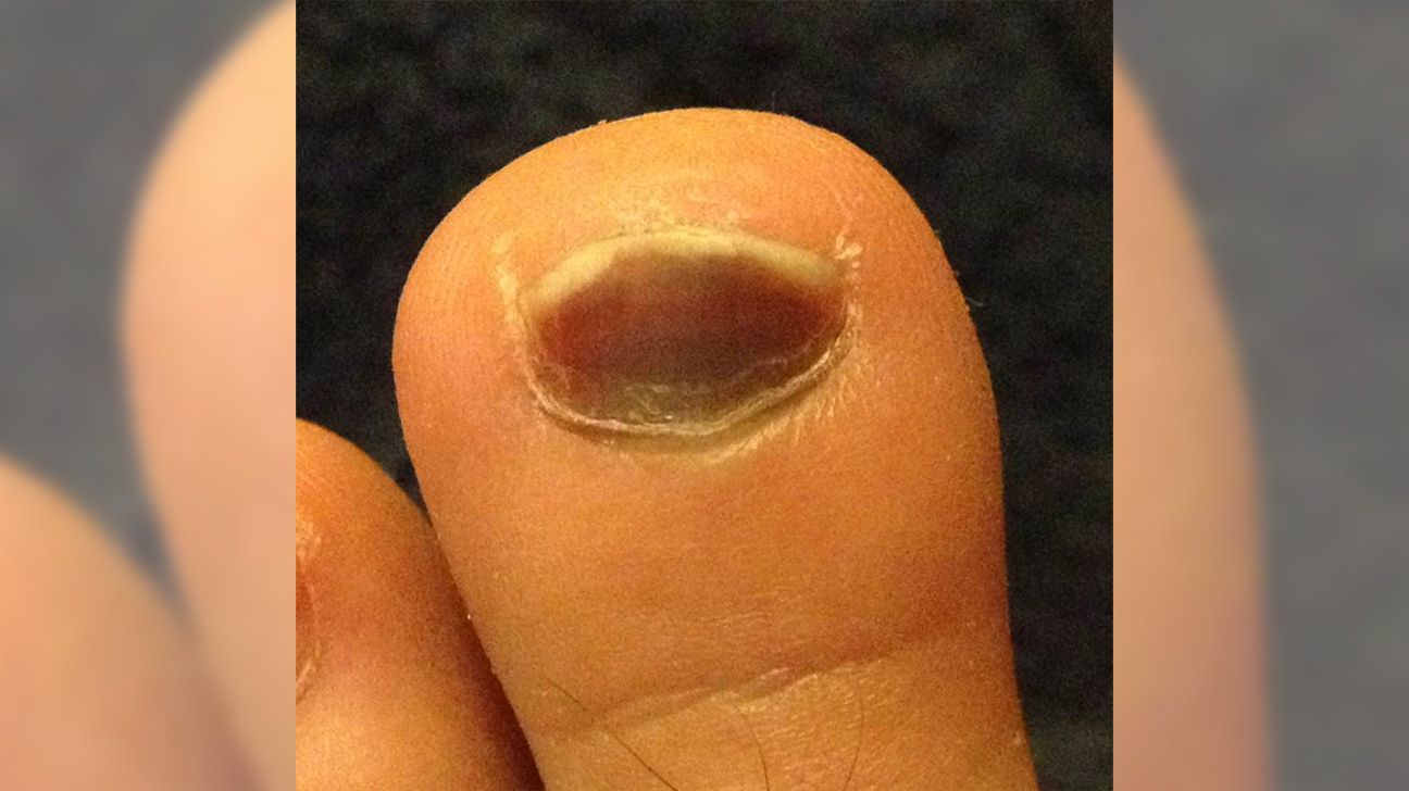 Nail Hematoma Bleeding Under Nail (Subungual Hematoma) Walk In Clinic