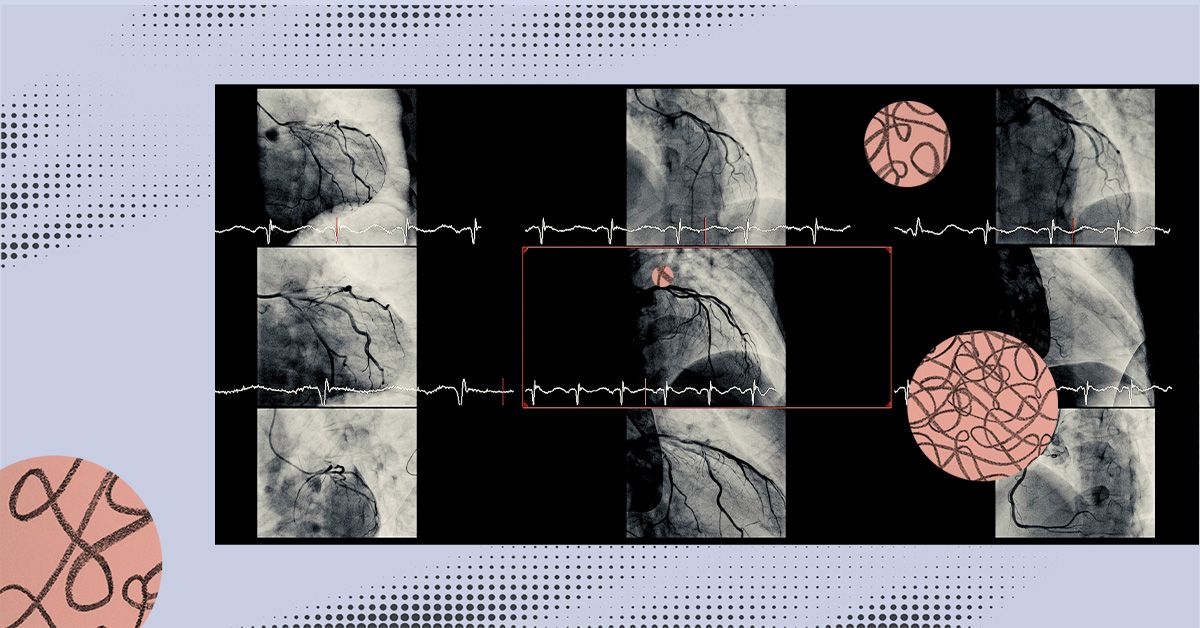 Osler Weber Rendu syndrome Radiology: Types of tests and more