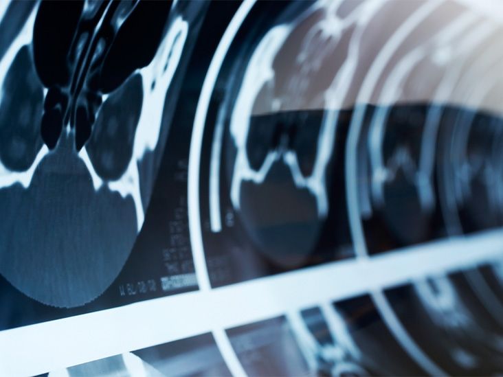 ICANS: Symptoms, causes, grading, and treatment