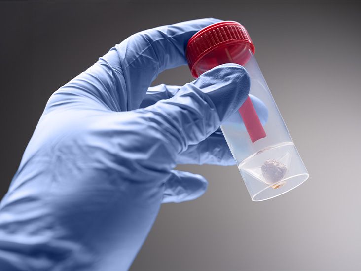 Stool test: Procedure, results, and more