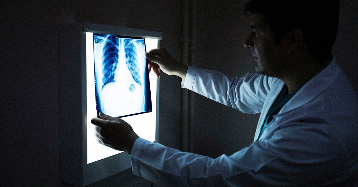 An overview of different types of lung cancer: Causes and treatment