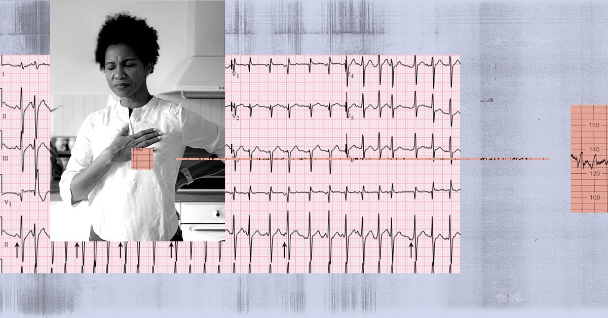 Multifocal atrial arrhythmia: Causes, symptoms, and more