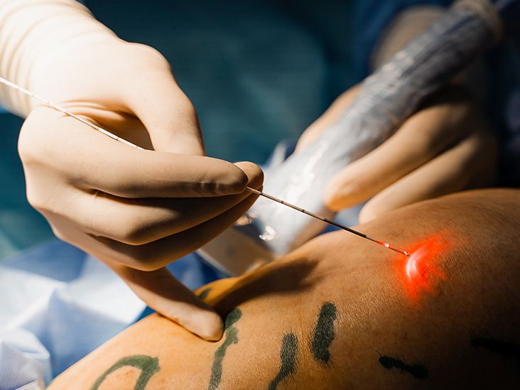 Endovenous laser treatment: Purpose, procedure, and recovery