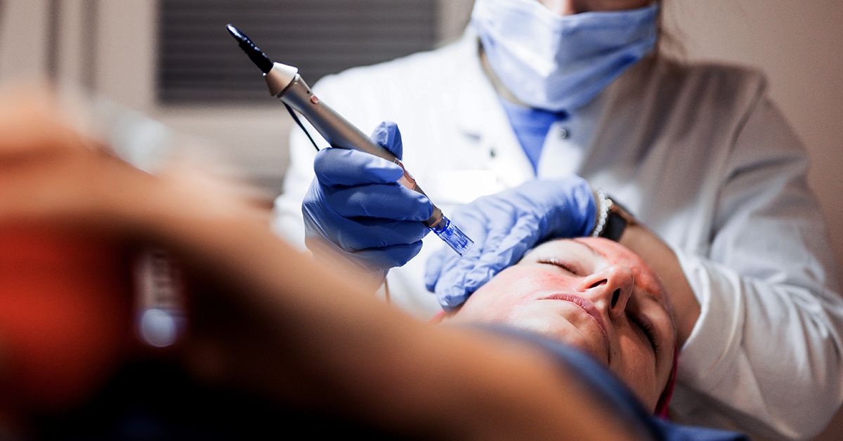 Microneedling for rosacea