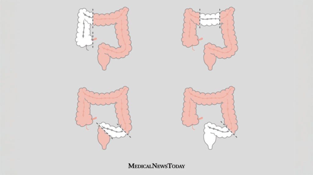 Crohn's disease surgery: Types, complications, and recovery