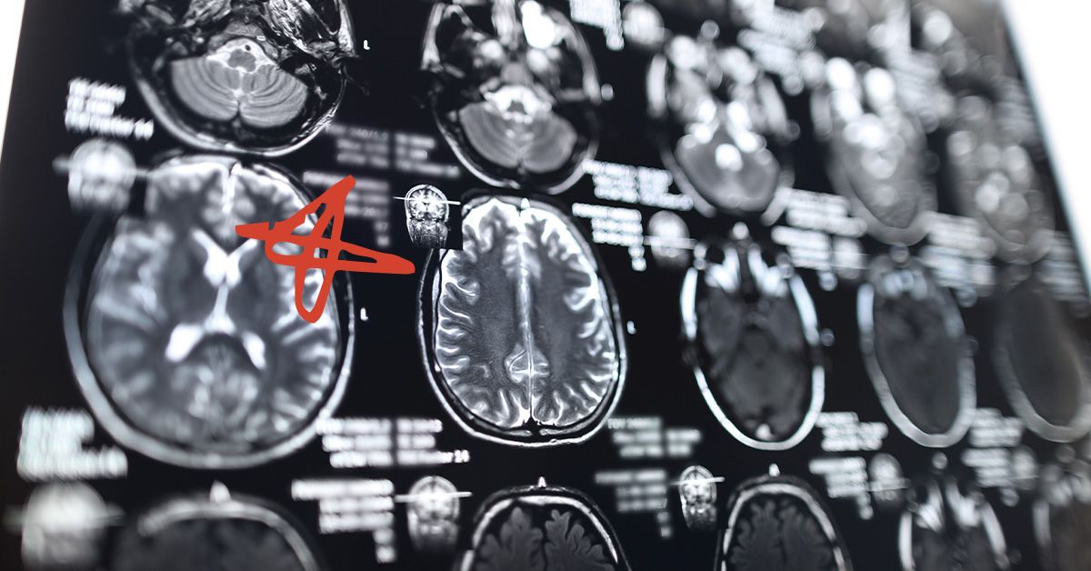 Stage IV brain cancer prognosis: What to know