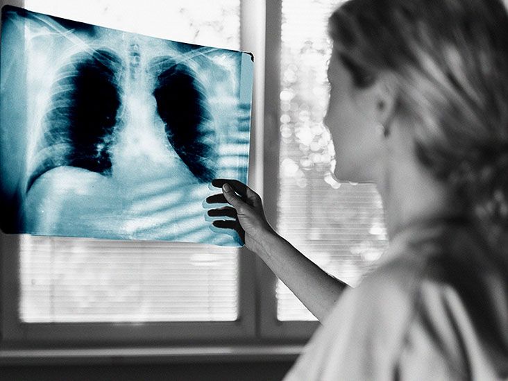 Small cell lung cancer staging: How it works