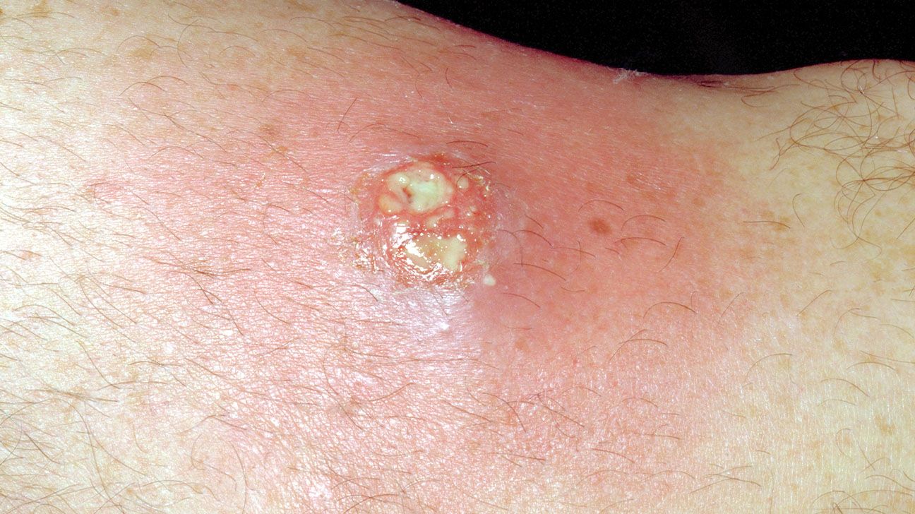 Infected Wound WOUND INFECTION