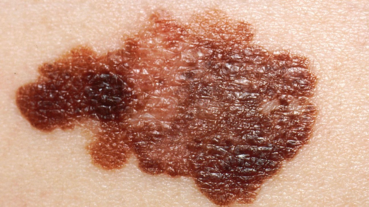 Early Superficial Spreading Melanoma