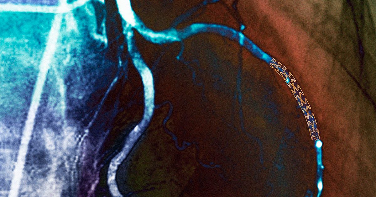 Stent thrombosis: Causes, complications, and prevention