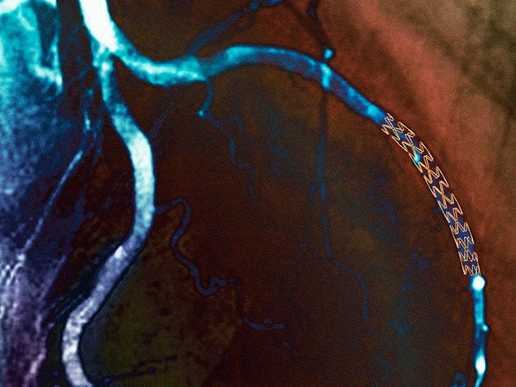 Stent thrombosis: Causes, complications, and prevention