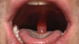 Uvula Swollen Tonsils, Adenoids, And Uvula