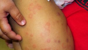 Hypocomplementemic Urticarial Vasculitis