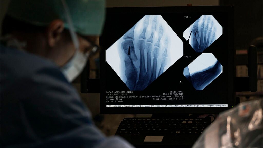 Open reduction ankle surgery: Procedure, recovery, and risks