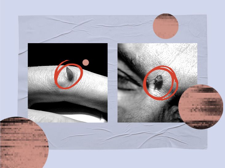 Cutaneous horn: Picture, causes, and symptoms